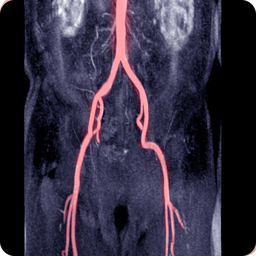 Arterite de Takayasu – Dra. Clarice Moura